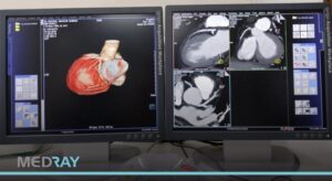 Computed tomography coronary angiography (cCTA) - MedRay
